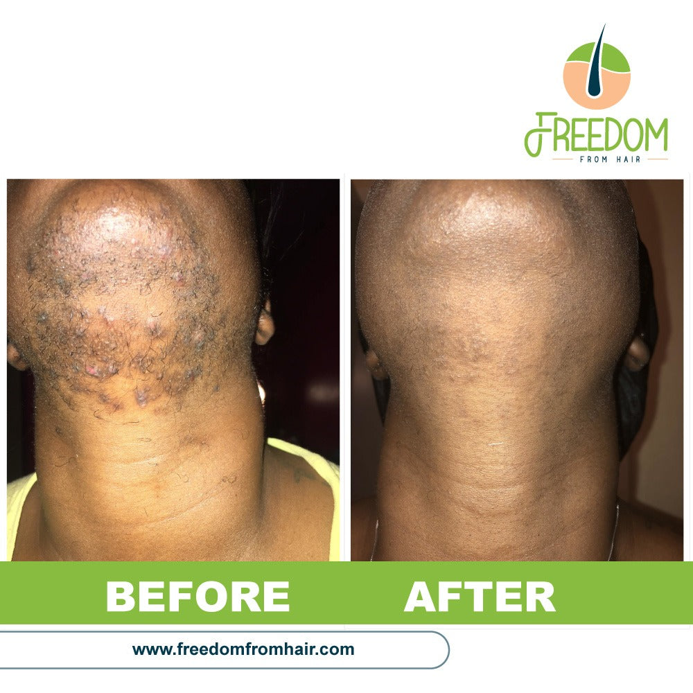 Freedom Facial Hair Removal Mask – freedomfromhair